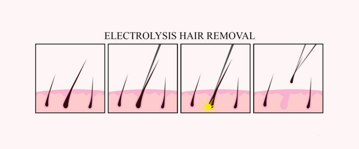 Benefits Of Electrolysis Hair Removal: What You Need To Know