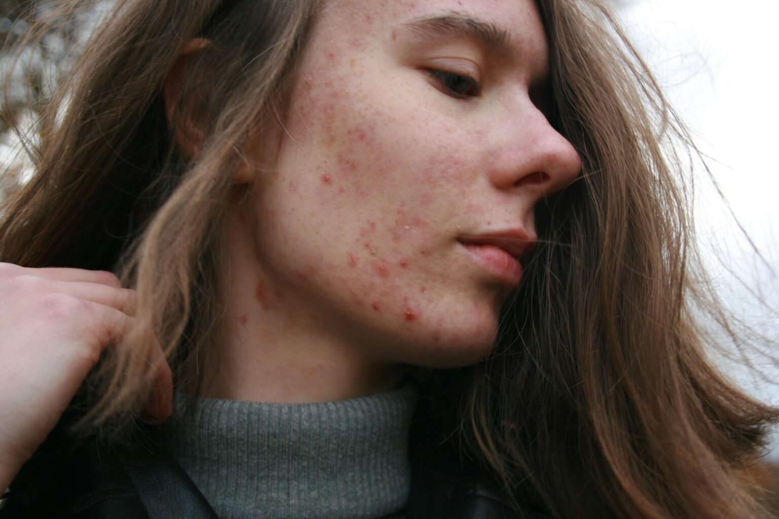 Acne Scar Treatments: Options For Severe Acne Scarring